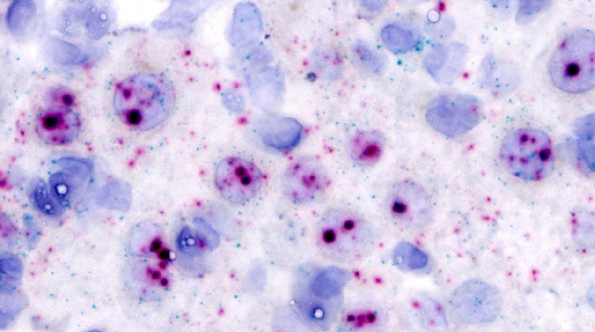 Discovery and description of the first human circovirus infection in ...